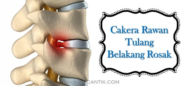 Sakit Slip Disc Leher | Ohcantik.com