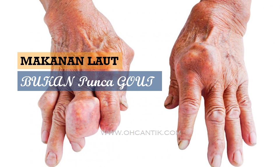 Punca GOUT Dan Cara Mengatasinya - Bukan Seafood! | Ohcantik.com