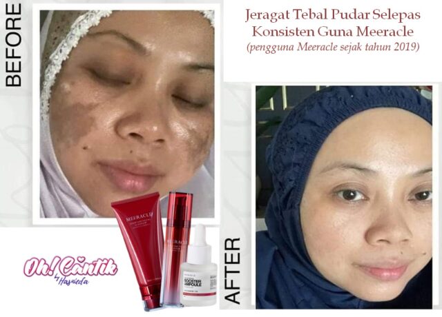 Produk Untuk Hilangkan Jeragat Yang Sangat Berkesan | Ohcantik.com